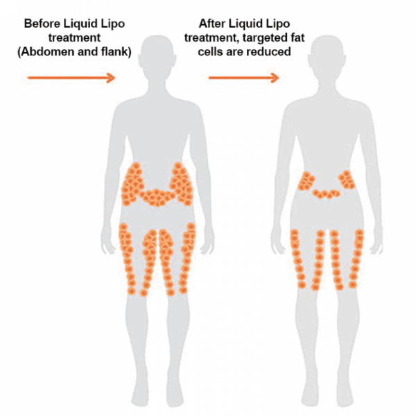 Liquid Lipo Fat Reduction Treatment in Nantwich Cheshire